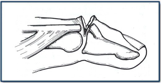 Sydney Hand Surgery » Mallet Finger