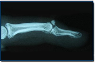 Sydney Hand Surgery » Mallet Finger
