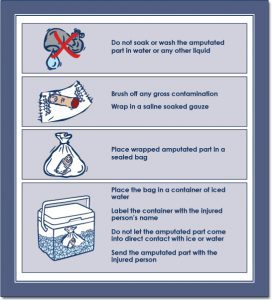 Sydney Hand Surgery Amputations | Sydney Hand Surgery